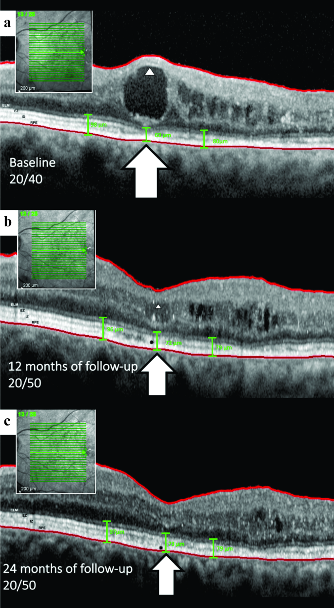 Structural effects of intraretinal cysts on outer retinal layers in ...